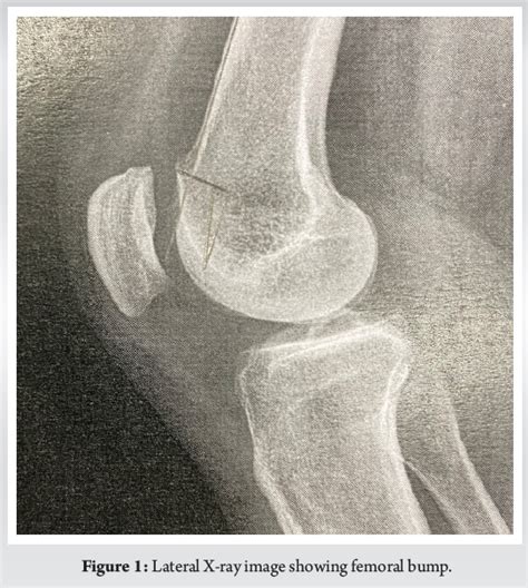 Chronic Flexion Patellar Dislocation With Femoral Patellofemoral