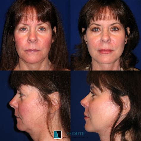 Nesmith Plastic Surgery Center