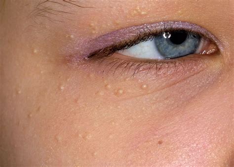 14 Causes Of A Pimple Like Rash