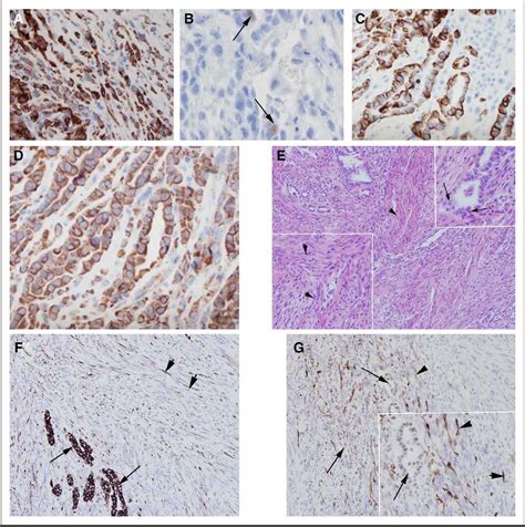 Figure 3 From A Rare Pericardial Malignancy Semantic Scholar