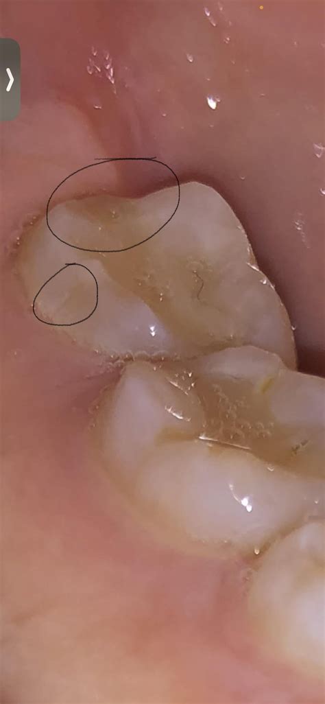 Crack In Tooth Raskdentists
