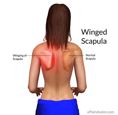 Winged Scapula Or Scapular Winging Causes Symptoms Treatment Exercise