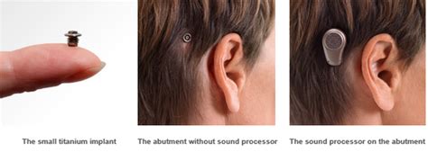 Bone Anchored Hearing Device Professional Hearing Center Audiologists