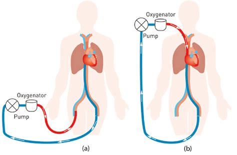 Illustration Of The Ecmo Circuit A Represents Venous Arterial And