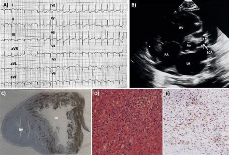 Enterovirus Acute Myocarditis A Ecg Revealed Sinus Rhythm Of 150
