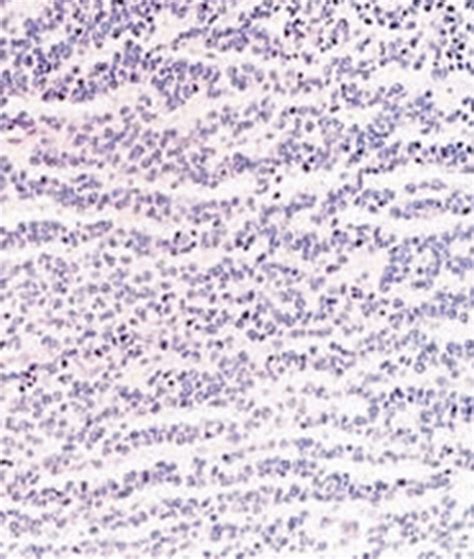 Radiologic Findings Of Peripheral Primitive Neuroectodermal Tumor Arising In The Retroperitoneum
