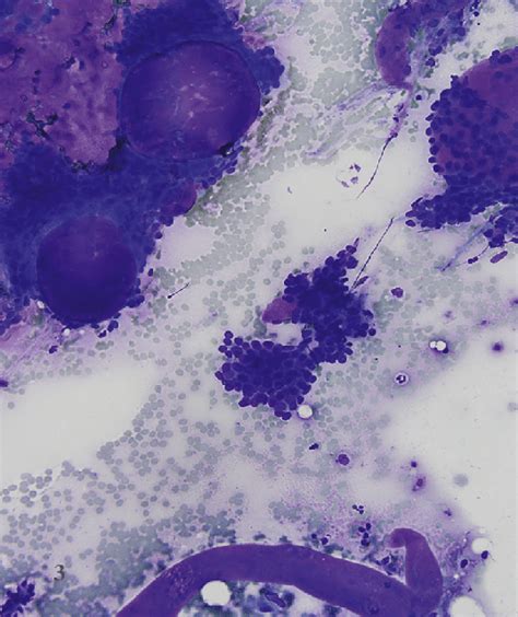 Adenoid Cystic Carcinoma X20 Diff Quik Figure 1 Mucoepidermoid Download Scientific Diagram