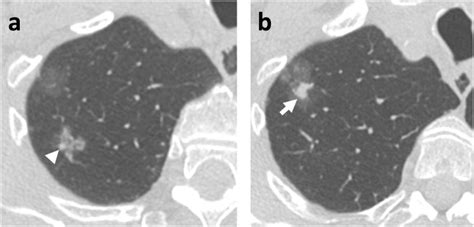 Subsolid Pulmonary Nodules Controversy And Perspective Pmc