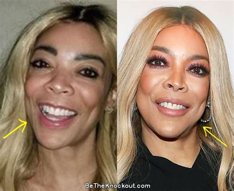Wendy Williams Plastic Surgery Comparison Photos
