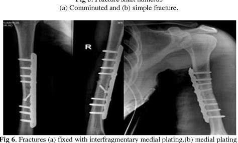 Figure 6 From Medial Plating Of Humerus Shaft Fractures Through
