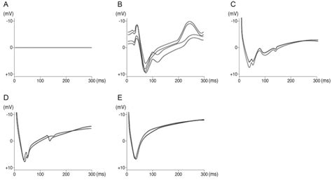 Electrically Evoked Potential Eep Of Optic Nerve Optic Track And