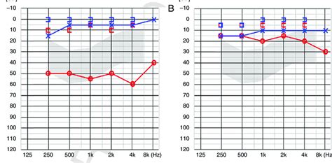 A Preoperative Pta Showed 54 Db Conductive Hearing Loss B