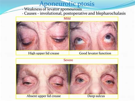 Ptosis Pptx Eye And Vision Conditions Diseases And Conditions
