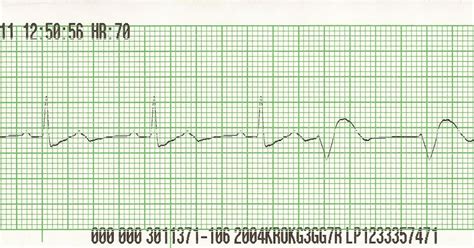 Ekg Rhythm Strips 18 Ventricular Ectopy 1