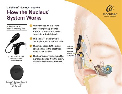 How Cochlear Implants Work — Appalachian Audiology