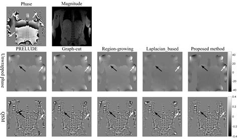 In This Work A Novel 3d Pu Method Ispresented The Simulated And In Vivo Abdominal Qsm