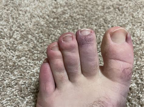 Why Does My Second Toe Look Like That And Should I Be Worried R