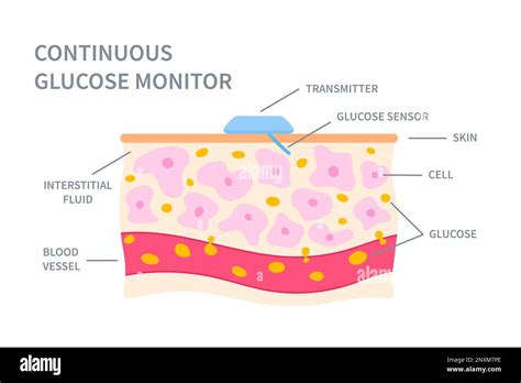 Continuous Glucose Monitor Sensor In Skin Illustration Stock Vector