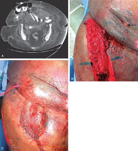 Open Inguinal Hernia Repair With Plug And Patch Technique