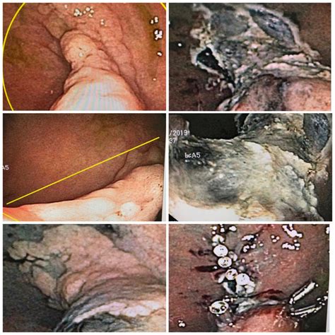 Challenging Large Sessile Carpet Polyp In Cecum Removed This Morning
