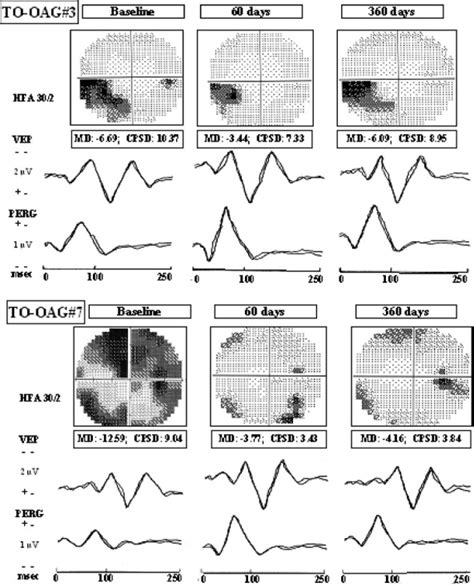 Citicoline A Neuroprotector With Proven Effects On Glaucomatous