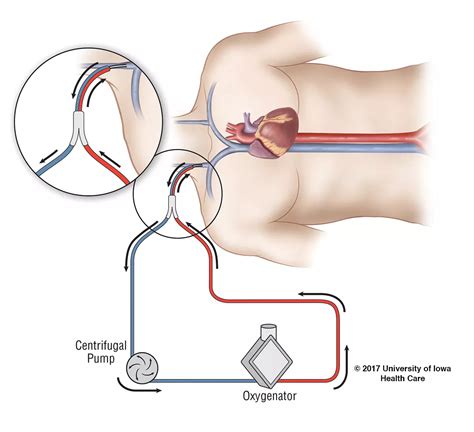 Different Types Of Ecmo University Of Iowa Health Care