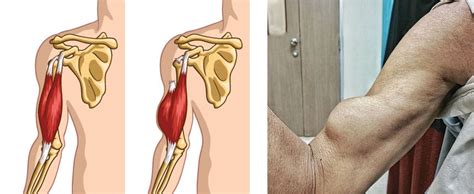 Biceps Femoris Bursitis