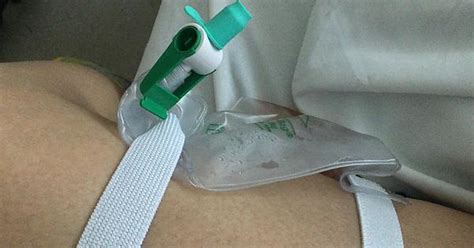 My Nephrostomy Bag Album On Imgur