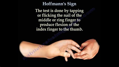 Hoffmanns Sign Everything You Need To Know Dr Nabil Ebraheim Youtube