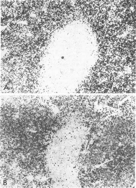 Cryostat Sections Of Thymoma Of Cortical Type With Medullary