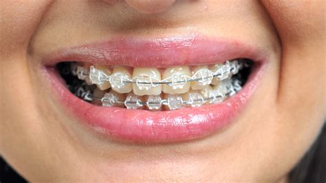 Reveal Your Best Smile The Superiority Of Lightforce Braces Local