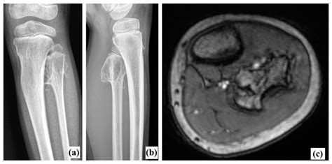 Preoperative X Rays Ab And Mri C Anterior Tibial Artery And Download Scientific Diagram