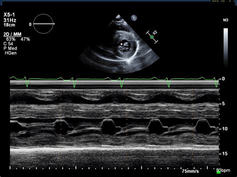 A Case Of Cardiac Amyloidosis With Left Ventricular Outflow Obstruction