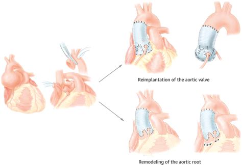 Valve Sparing Aortic Procedures The David Reimplantation Procedure Download Scientific Diagram