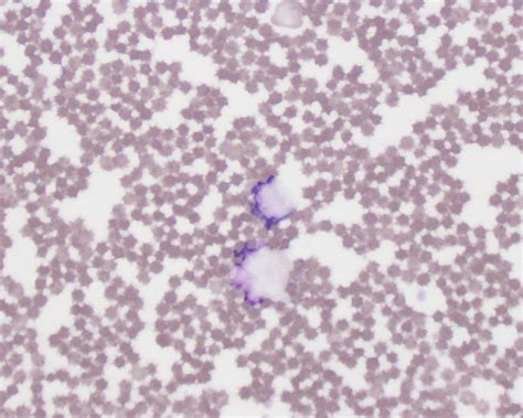 Echinocytes Archives Eclinpath