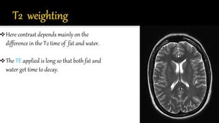 Mri Principles Weighting And Contrast Pptx