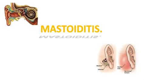 Mastoditis Pptx