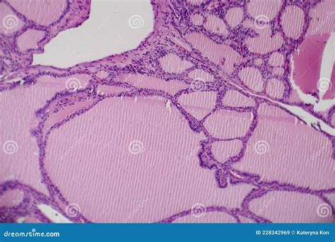 Histopathology Of Endemic Goitre Stock Image Image Of Body Medical 228342969
