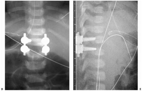 Osteochondral Defect Of The Talus Teachme Orthopedics