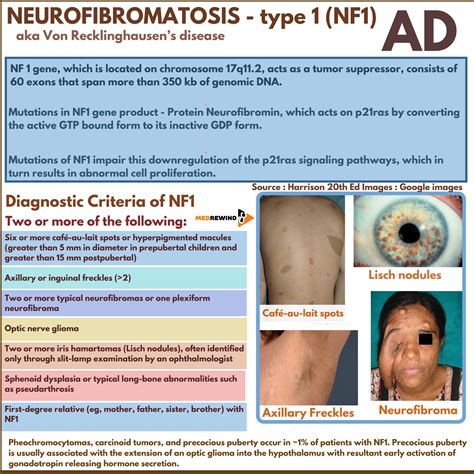 Neurofibromatosis Type 1 Lisch Nodules