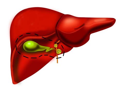 Gallbladder Surgery Perth Gallbladder Removal Surgeon And Specialist