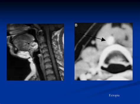 Ppt Imaging Of Thyroid Gland Powerpoint Presentation Free Download