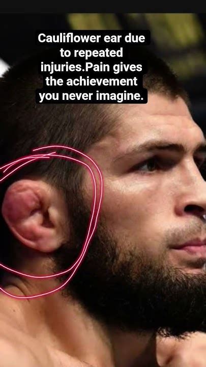 Cauliflower Ear 👂 Of Ufc Fighter Khabib The Legend Youtube