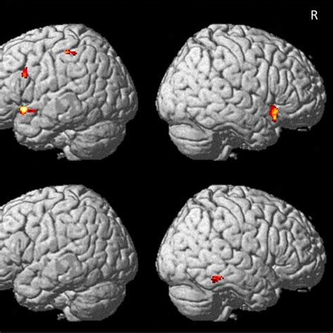 Voxel Based Morphometry Vbm Lower Gray Matter Volume In Older Women