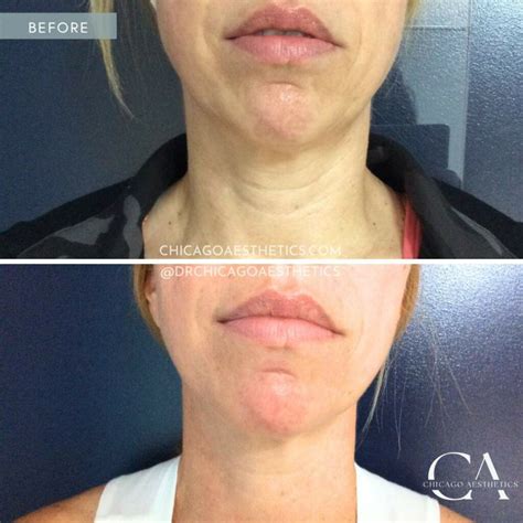Sofwave Before After Photos Chicago Aesthetic Surgery And Med Spa