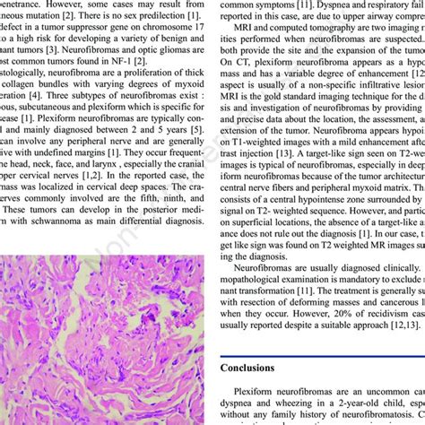 Proliferation Consisting Of Spindle Shaped Cells With Small Undulating