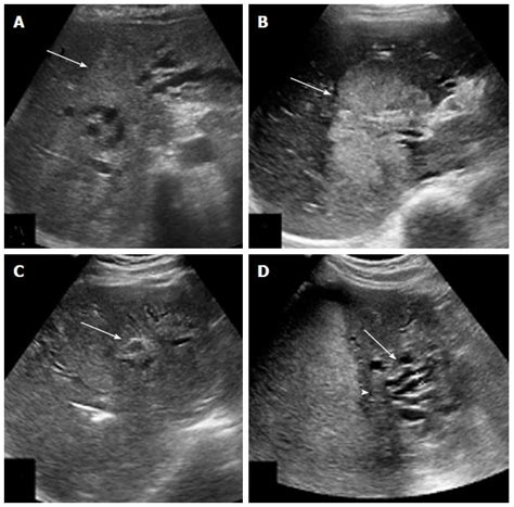 Cholangiocarcinoma Ultrasound