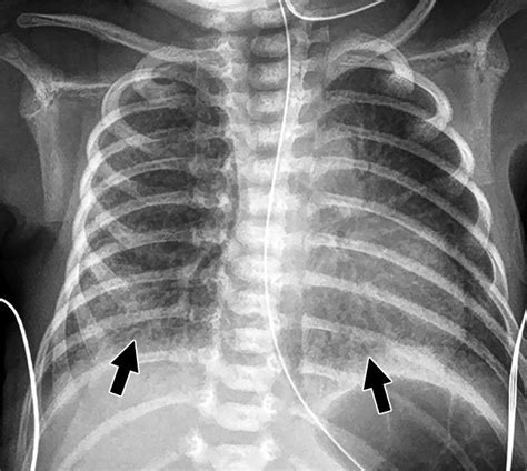 Neonatal Lung Disorders Pattern Recognition Approach To Diagnosis Ajr