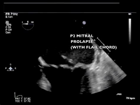 Mitral Valve Prolapse The Definitive Guide • Myheart