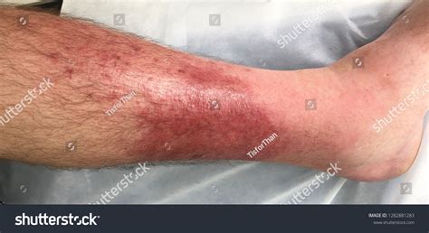 Cellulitis Knee